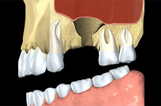 What is the best treatment for bone loss in teeth? Can be saved?