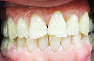 Non prep veneers, no prep veneers - BestDentalImplants