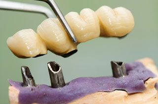 Dental bridge, dental bridge procedure